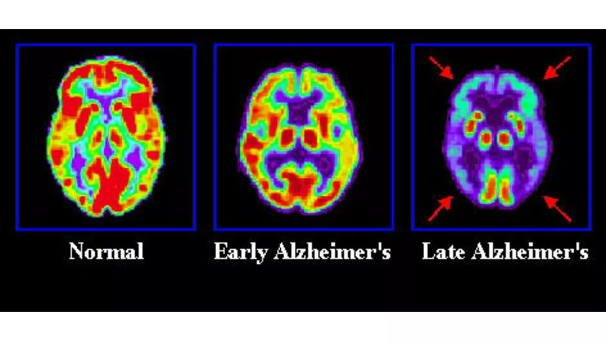 Une IA pour détecter Alzheimer