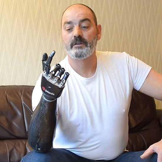 Bebionic3 : La prothèse de main la plus évoluée à ce jour