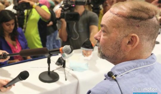 Première mondiale : un patient subit une greffe de crâne et de cuir chevelu